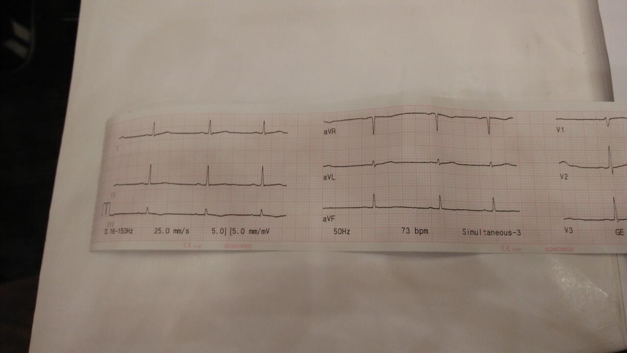 HELP! HASIL EKG ABNORMAL (yang bisa baca hasil EKG masuk!) | KASKUS