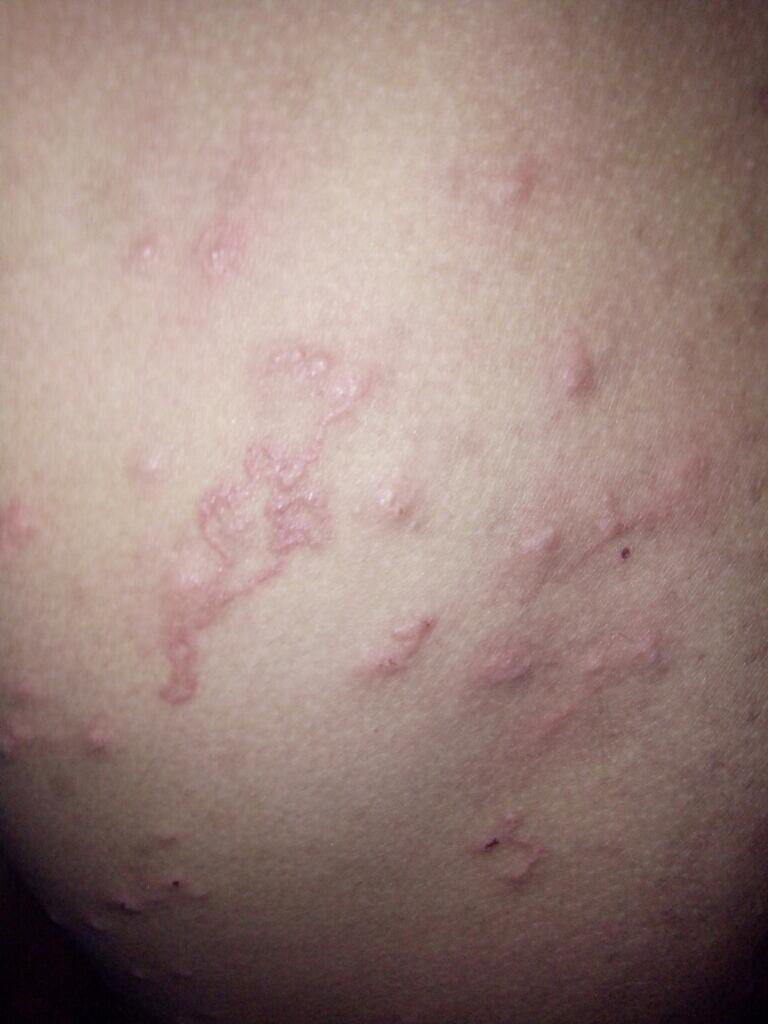 Larva Cacing Pindah Didalam Kulit / Cutaneous Larva Migrans | KASKUS