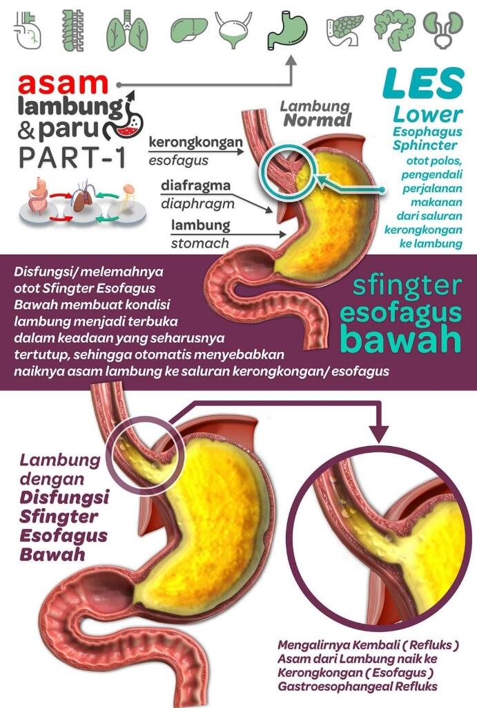 Asam Lambung Dapat Menjadi Penyebab Kematian Mendadak? Penjelasan Simon ...