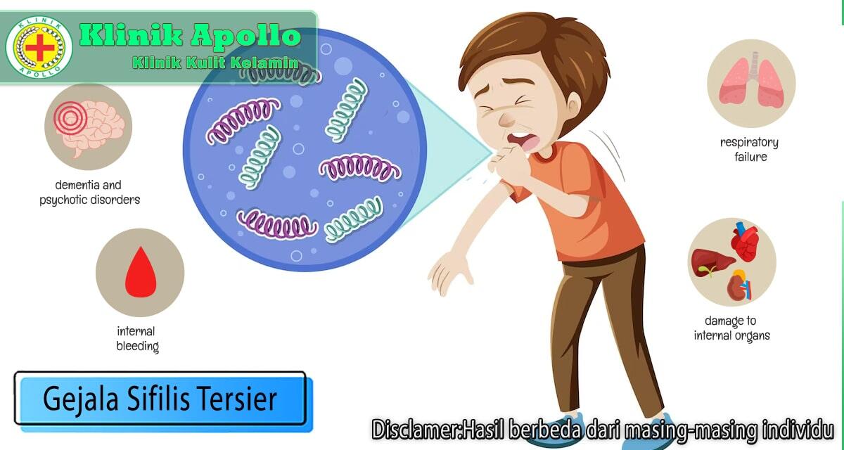 3 Gejala Sifilis Tersier Tahapan Yang Dapat Merusak Tubuh Kaskus