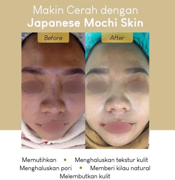 Japanese Mochi Skin di Immoderma Skin Clinic Semarang | KASKUS