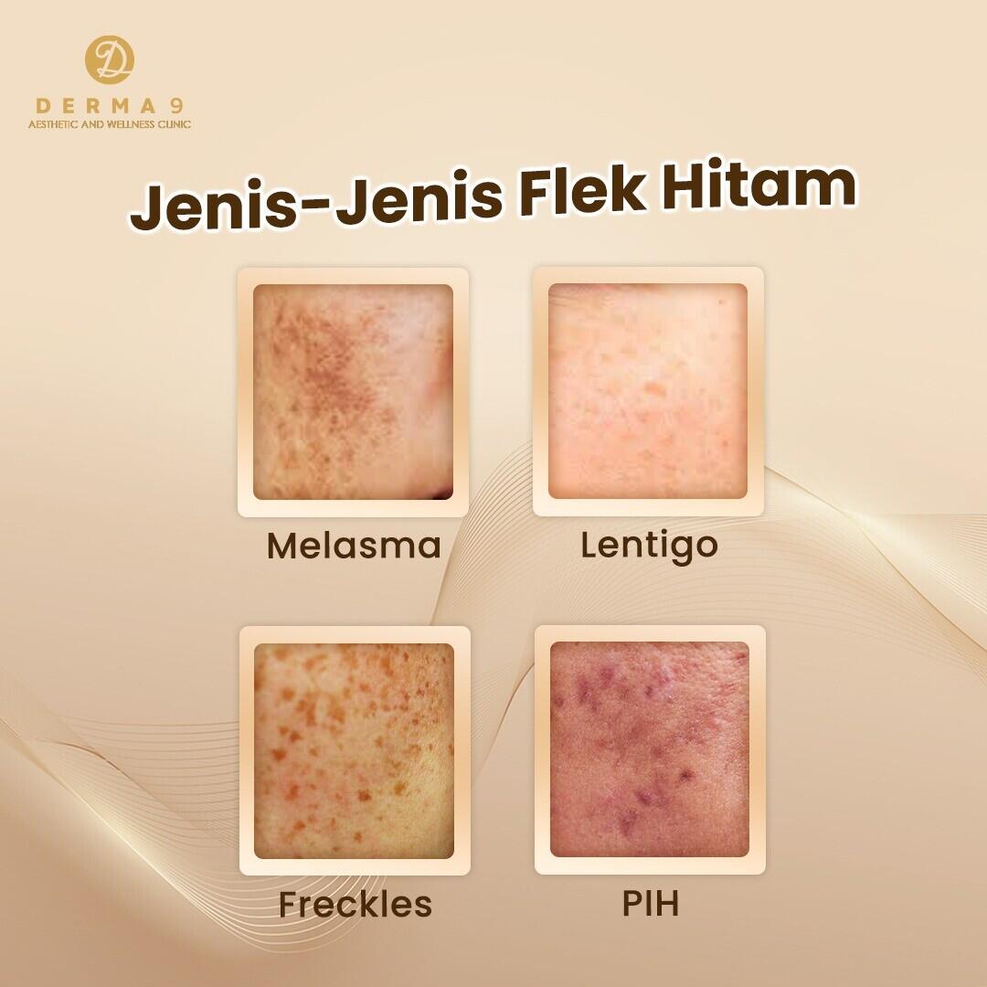 Yukk Kenali Jenis Jenis Flek Hitam dan Cara Mengatasinya | KASKUS